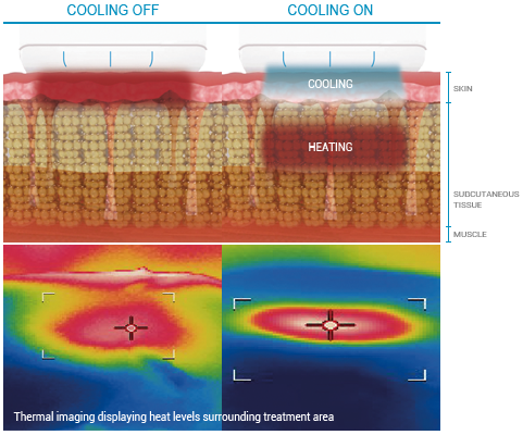 CONTACT-COOLING-CONTROL | ULTRAFORMER